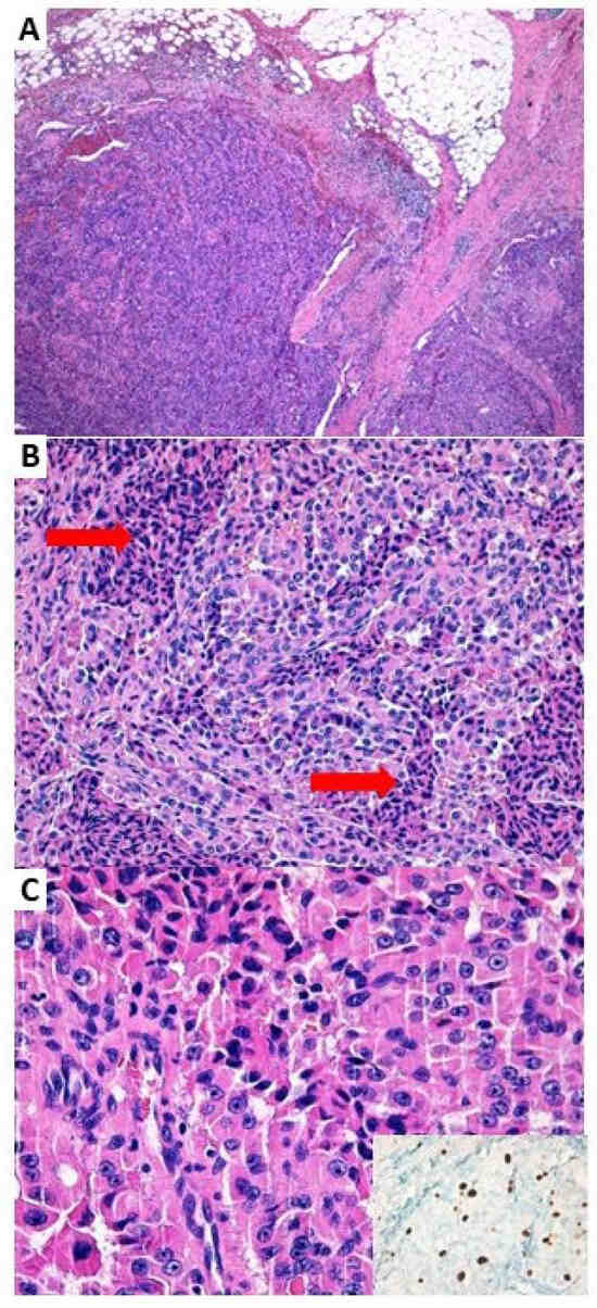 BRAF K601E Mutation in Oncocytic Carcinoma of the Thyroid: A Case ...