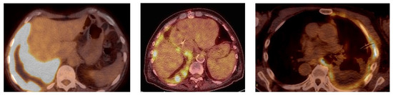 Pleural Uptake Patterns in F18Fluorodeoxyglucose-Positron Emission ...
