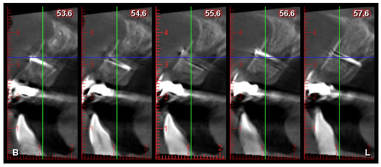 JCM | Free Full-Text | Digital Evaluation of Vertical Ridge ...