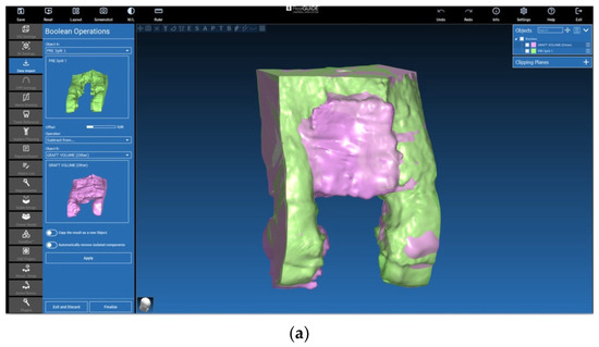 JCM | Free Full-Text | Digital Evaluation of Vertical Ridge ...