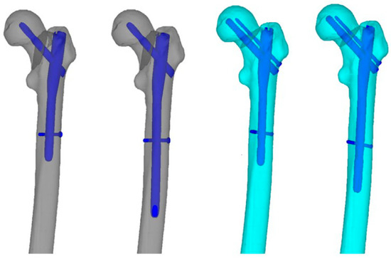 Characteristics and Treatment Strategies for Basicervical and ...