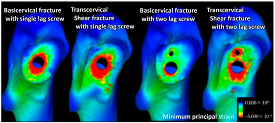 Characteristics and Treatment Strategies for Basicervical and ...