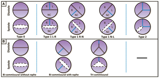 Transcatheter Aortic Valve Implantation for Bicuspid Aortic Valve ...