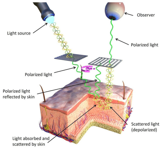 Assessing Excessive Keratinization in Acral Areas through Dermatoscopy ...