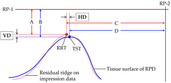 Morphological Comparison of Residual Ridge in Impression for Removable ...