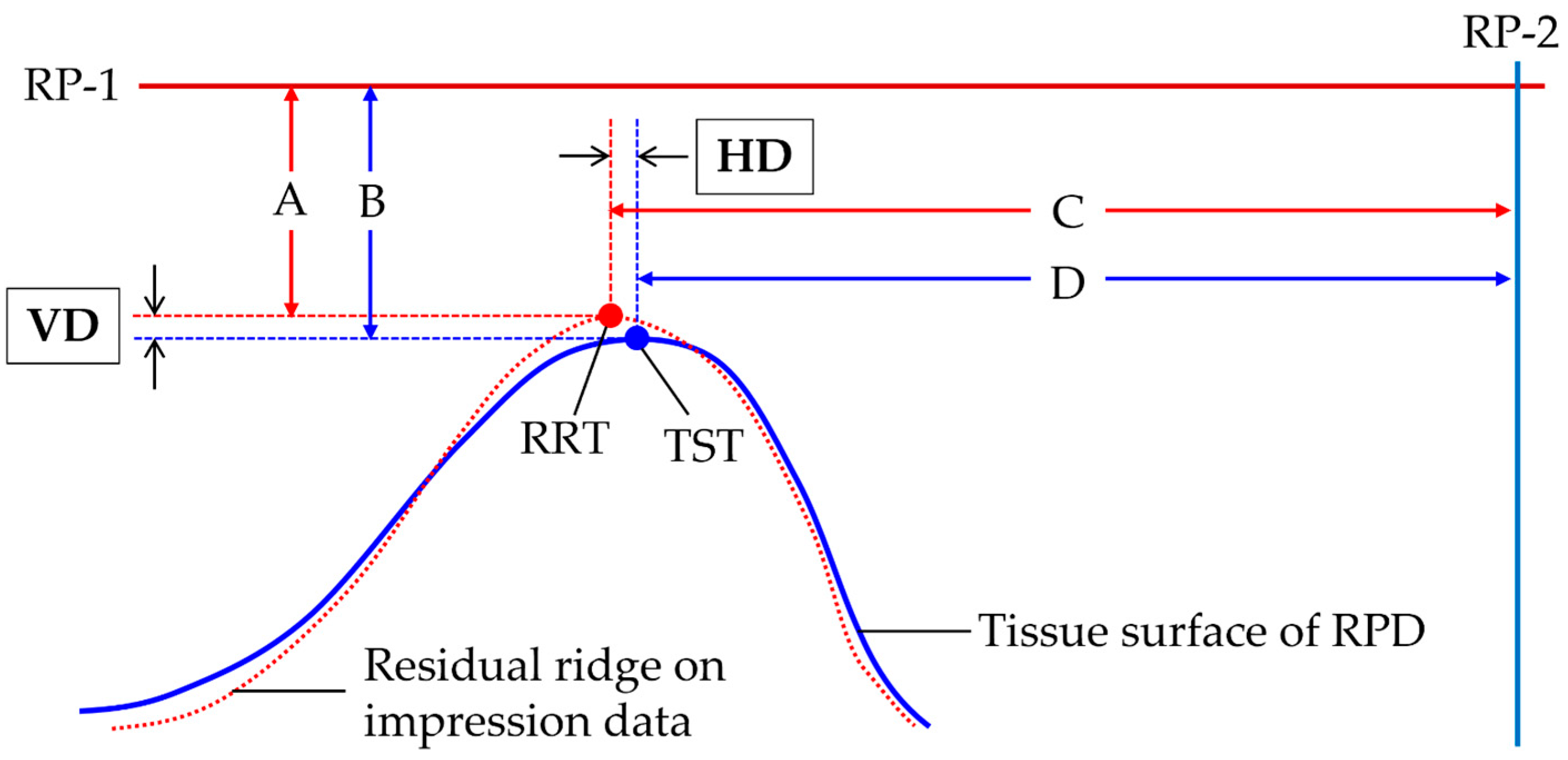 Morphological Comparison of Residual Ridge in Impression for Removable ...