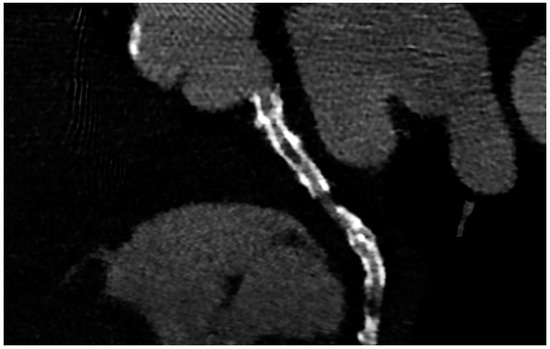 Cardiac Computed Tomography in Monitoring Revascularization