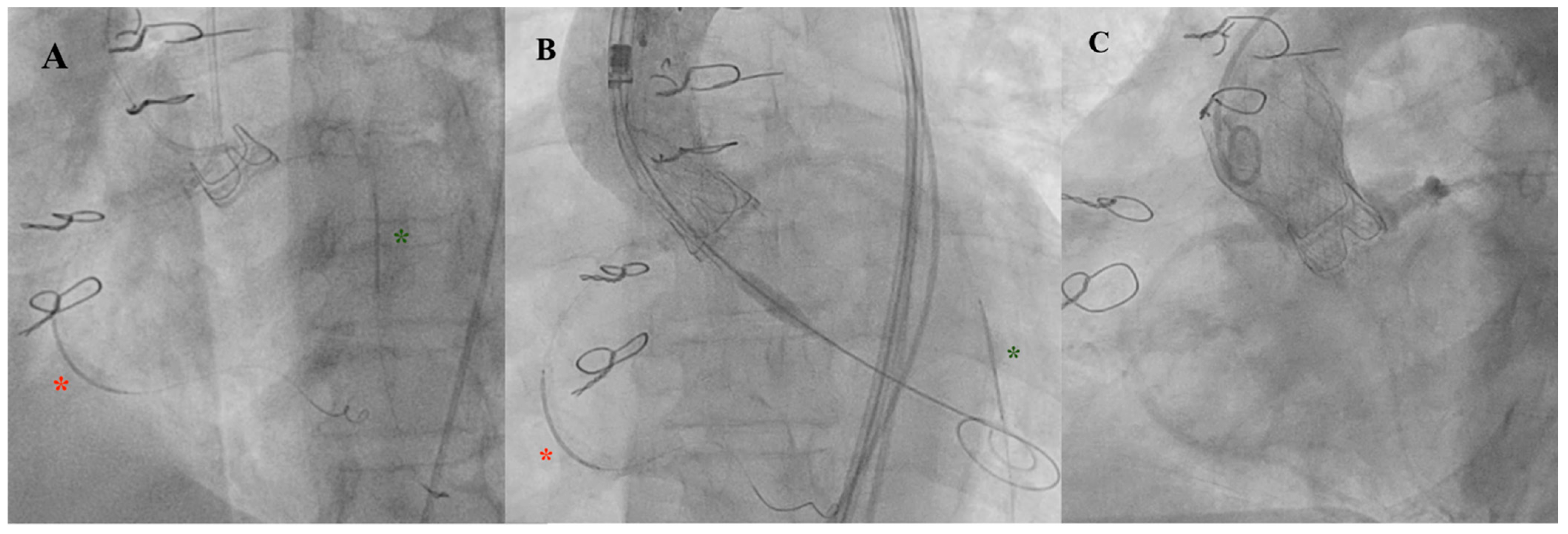 The Management of Coronary Artery Disease in TAVR Patients
