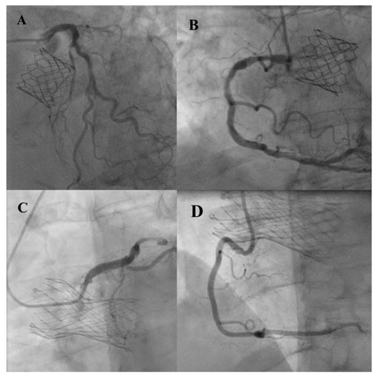 The Management of Coronary Artery Disease in TAVR Patients