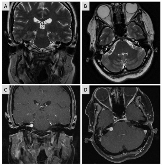 Middle Ear Cholesteatoma and Vestibular Schwannoma Resection Followed ...
