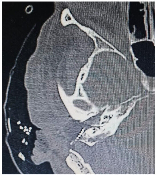 Middle Ear Cholesteatoma and Vestibular Schwannoma Resection Followed ...