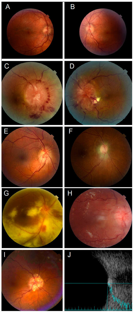 Optic Disc Swelling in Cancer Patients: Etiology and Implications