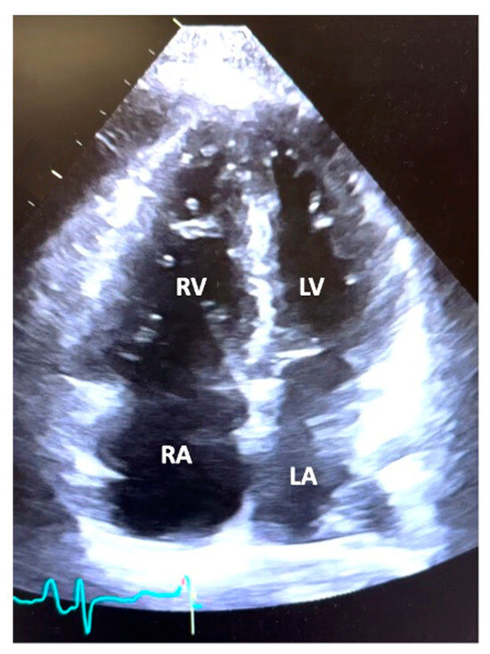 Intravenous Diuresis in Severe Precapillary Pulmonary-Hypertension ...