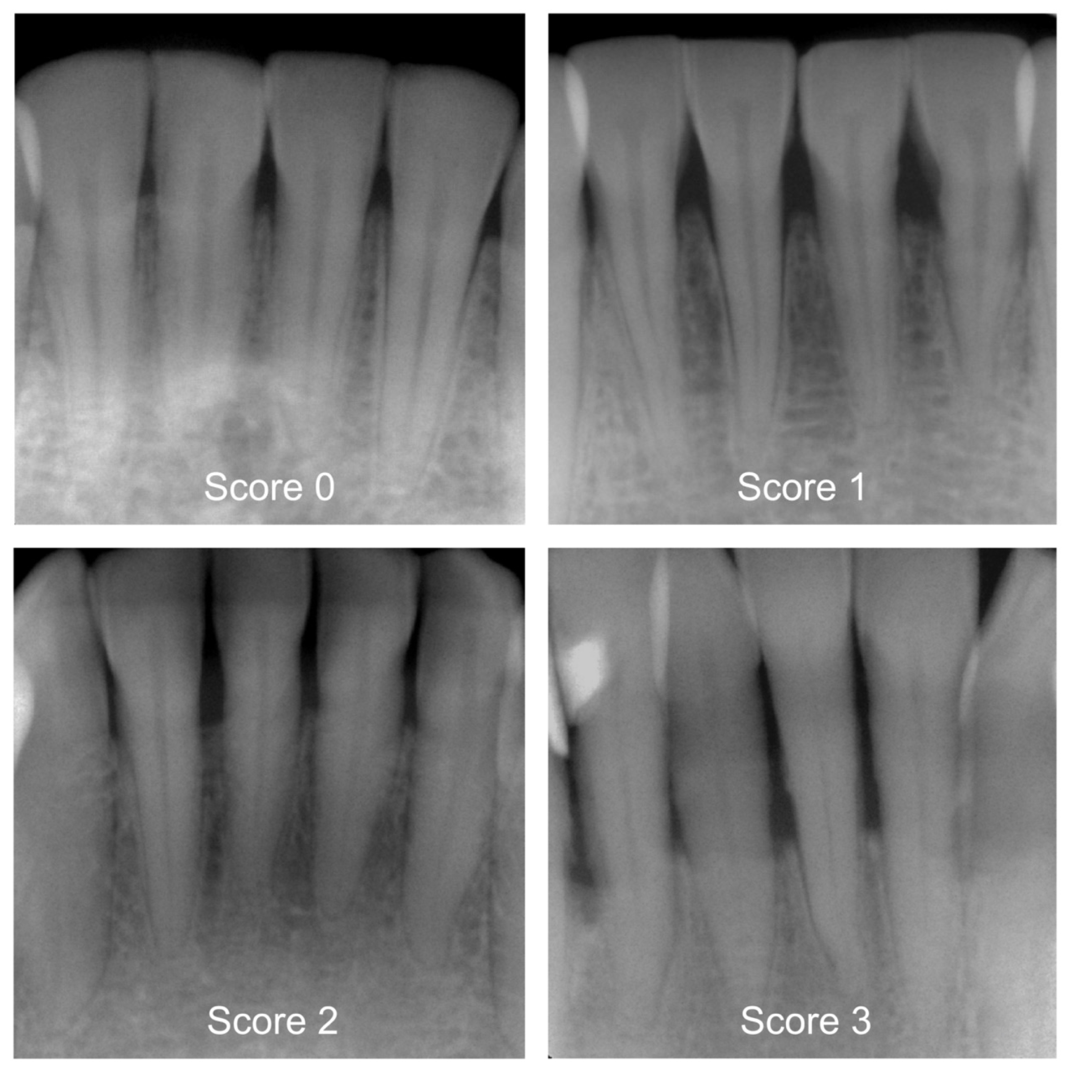 Treat Bone Loss Teeth At Gail Carroll Blog