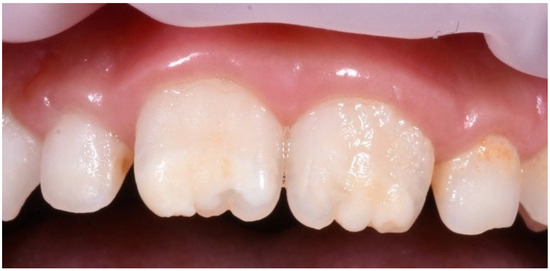 Treatment Approaches to Molar Incisor Hypomineralization: A Systematic ...