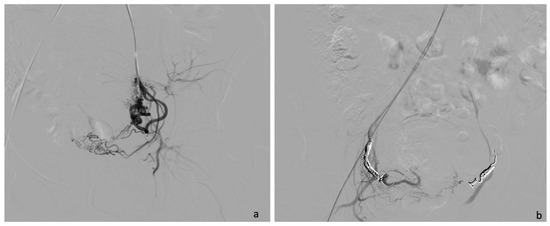 MRI Assessment of Cesarean Scar Pregnancies: A Case Series