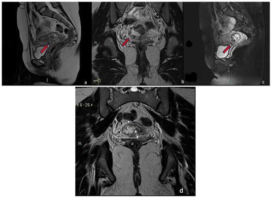 MRI Assessment of Cesarean Scar Pregnancies: A Case Series