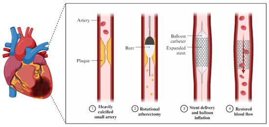 Rotational Atherectomy, Orbital Atherectomy, and Intravascular ...