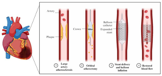 Rotational Atherectomy, Orbital Atherectomy, and Intravascular ...