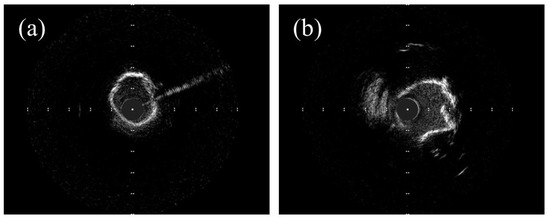 Rotational Atherectomy, Orbital Atherectomy, and Intravascular ...