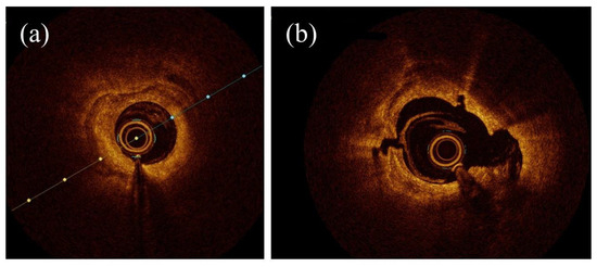 Rotational Atherectomy, Orbital Atherectomy, and Intravascular ...