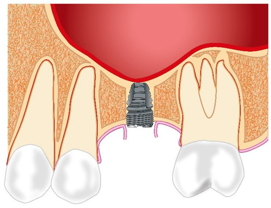 Preprosthetic Surgery—Narrative Review and Current Debate