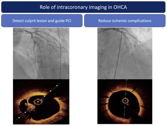 Percutaneous Coronary Intervention in Out-of-Hospital Cardiac Arrest Related to Acute Coronary ...