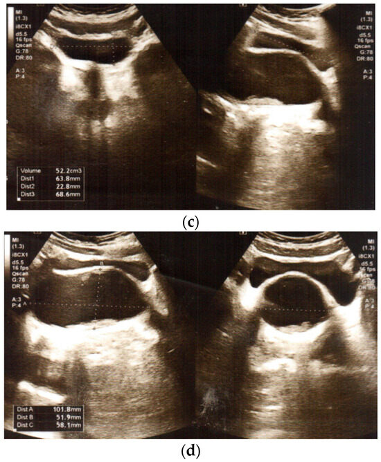 The Need for Earlier Diagnosis of Obstructed Hemivagina and Ipsilateral ...