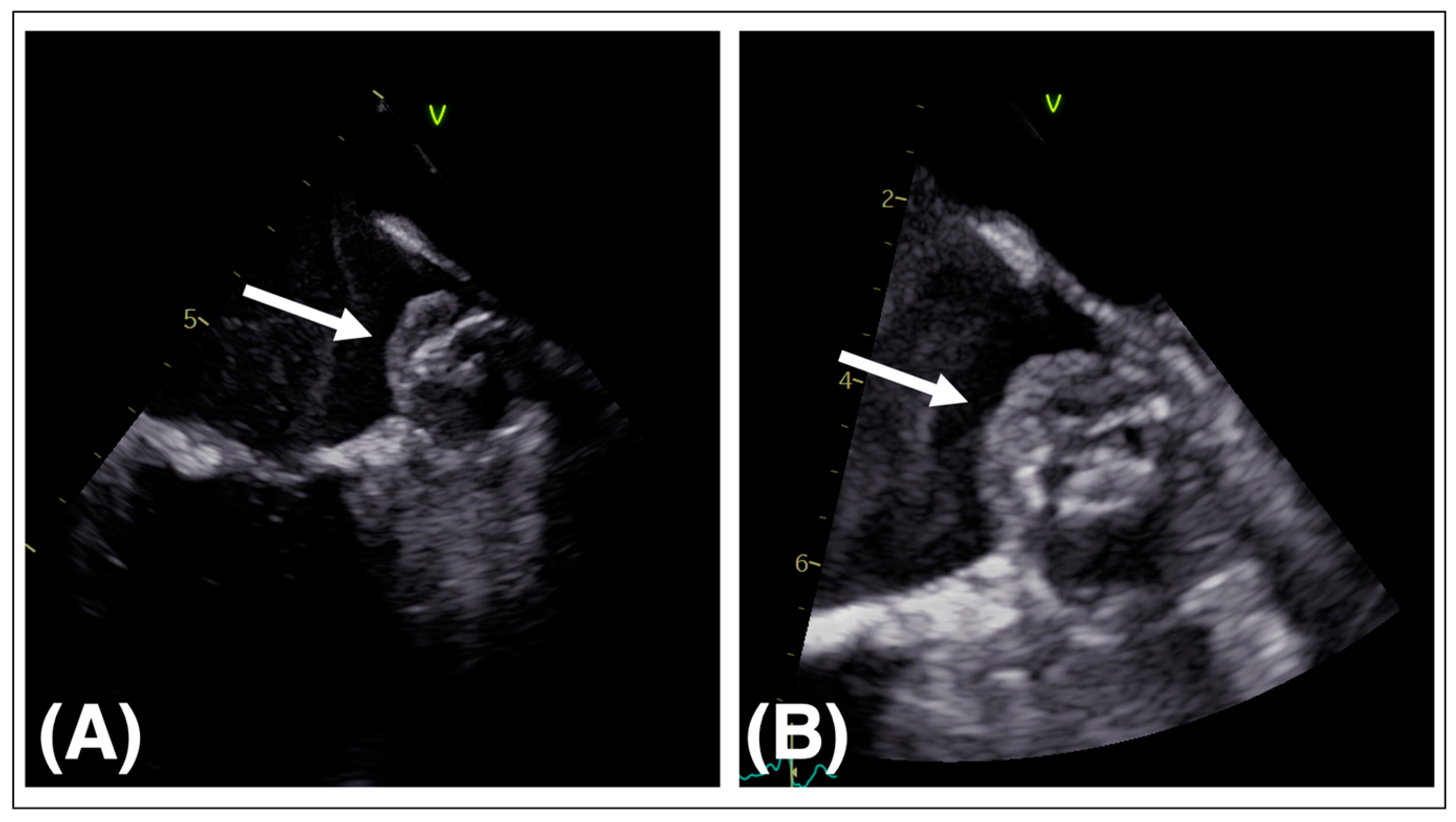 Percutaneous Left Atrial Appendage Occlusion—Current Evidence and ...