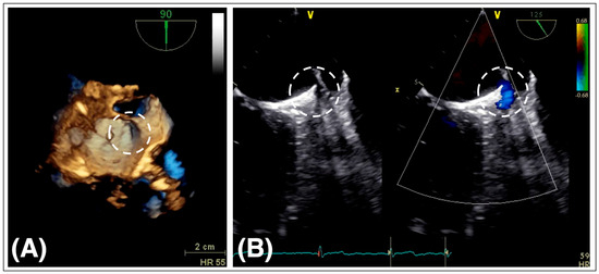 Percutaneous Left Atrial Appendage Occlusion—Current Evidence and ...
