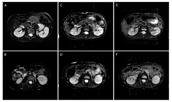 Local MRI before and after Tumor Resection in Neuroblastoma: Impact of ...