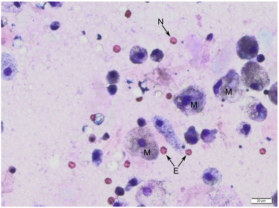 Grossly Bloody Colostrum—The Need for Staff Education and Maternal Support