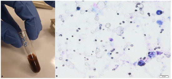 Grossly Bloody Colostrum—The Need for Staff Education and Maternal Support