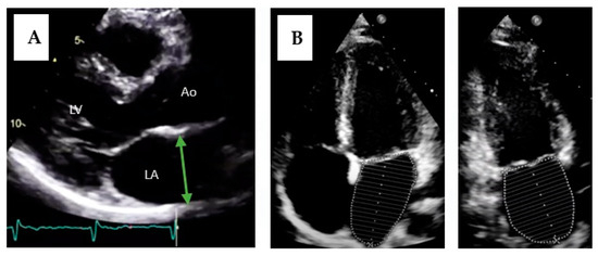 Interatrial Block, Bayés Syndrome, Left Atrial Enlargement, and Atrial ...