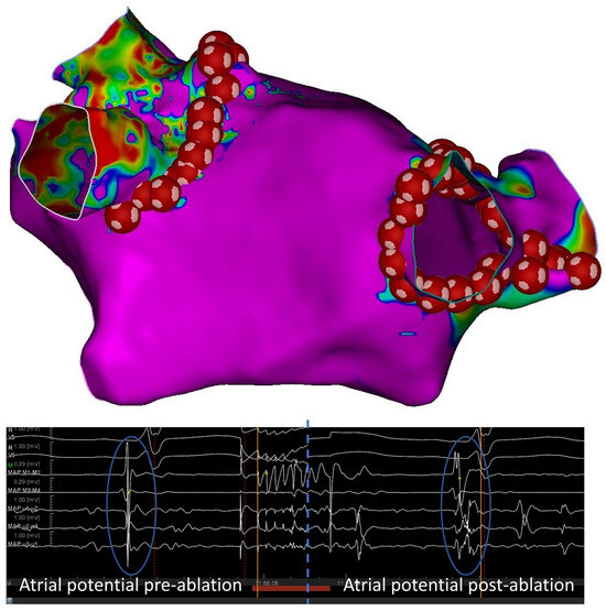 Biophysical Behavior of Very High-Power Short-Duration Radiofrequency Ablation in Pulmonary Vein ...