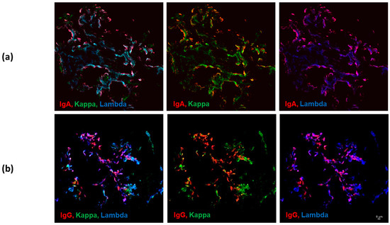 Colocalization of IgG and IgA Heavy Chains with Kappa and Lambda Light Chains in Glomerular ...