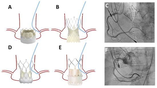 The Incidence, Impact, and Techniques of Commissural Alignment in ...