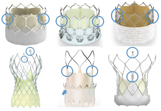 The Incidence, Impact, and Techniques of Commissural Alignment in ...