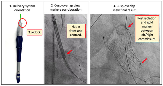 The Incidence, Impact, and Techniques of Commissural Alignment in ...