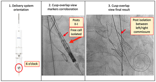 The Incidence, Impact, and Techniques of Commissural Alignment in ...