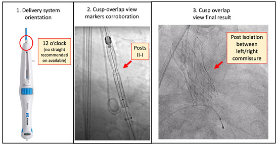 The Incidence, Impact, and Techniques of Commissural Alignment in ...