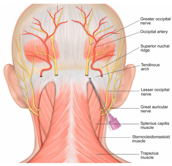 Jcm Free Full Text Effect Of Repeated Greater Occipital Nerve Block