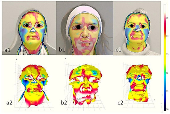 Exploring Facial Thermography Patterns in Women with Chronic Migraine