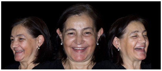 Immediate Loading of Zygomatic Implants Using a Dual Scan Technique