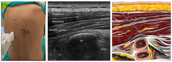 The Effectiveness of Ultrasound-Guided, Continuous, Bilateral Erector ...