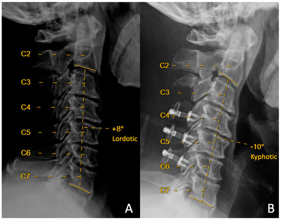 Multilevel Laminoplasty for CSM: Is C3 Laminectomy Better Than C3 ...