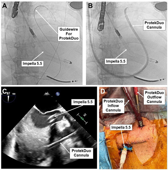 JCM | Free Full-Text | Test Bench for Right Ventricular Failure ...