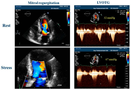 Exercise Stress Echocardiography in Athletes: Applications, Methodology ...
