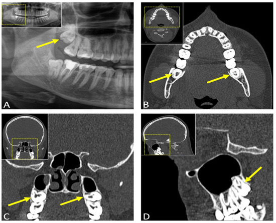 Imaging in Third Molar Surgery: A Clinical Update