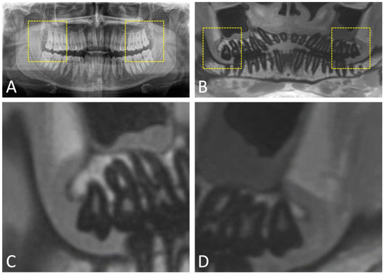 Imaging in Third Molar Surgery: A Clinical Update